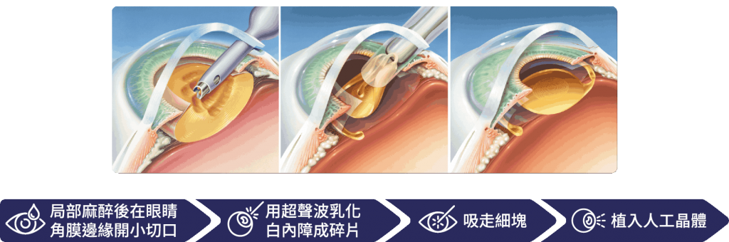 Understand the causes, symptoms, and ultrasound cataract treatment ...