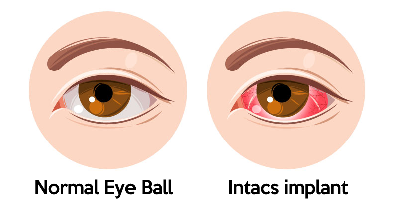 Ocular surface and corneal diseases: cornea conus, iritis | Corneal ...