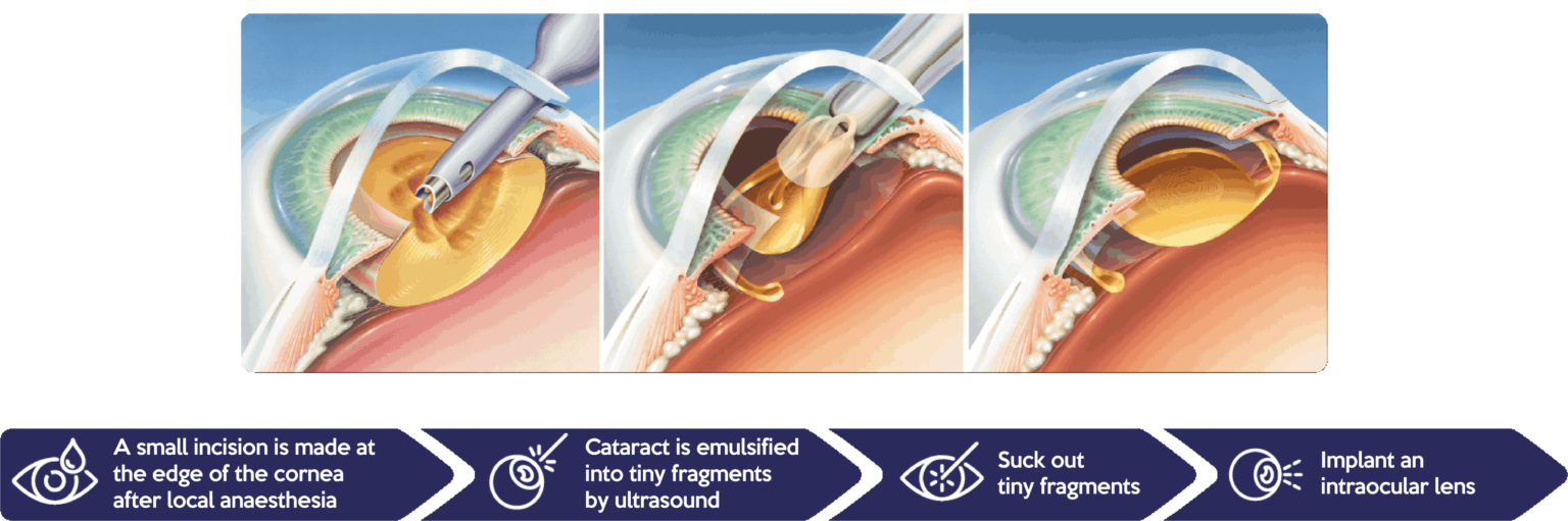 Understand the causes, symptoms, and ultrasound cataract treatment ...