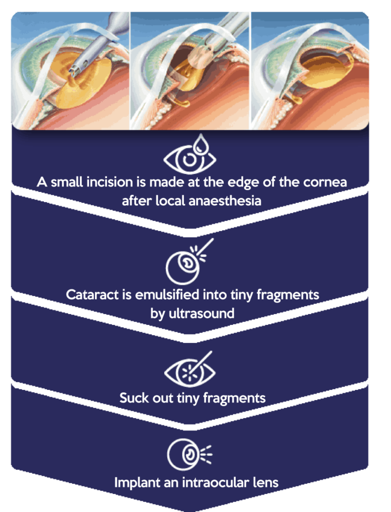 Understand the causes, symptoms, and ultrasound cataract treatment ...